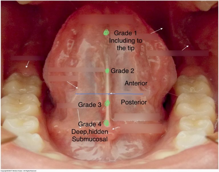 Dr. Kim Discussions: Understand a tongue tie diagnosis